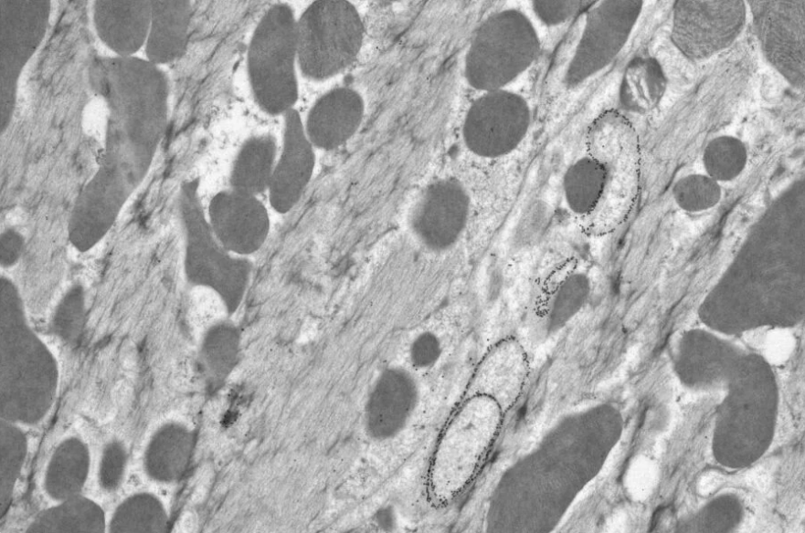 Webinar: Deep Visual Proteomics Reveals Early Drivers of Ovarian Cancer ...