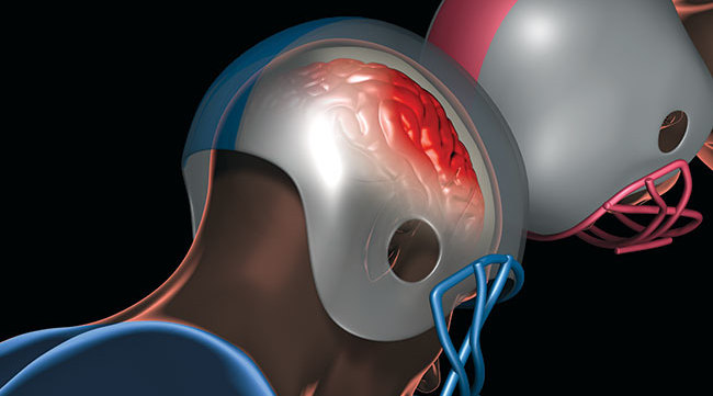Webinar: Understanding Concussions | Youth, High School & College ...
